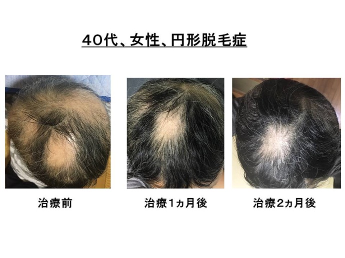 遠隔診療で治療中の、円形脱毛症の患者様、治療2ヵ月で効果！ 患者様からの声・メディア掲載・クリニックからのお知らせ 名古屋kクリニック